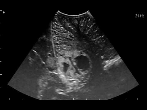 Aloka BrainPath Ultrasound Probe: Localizing Cerebellar Lesion