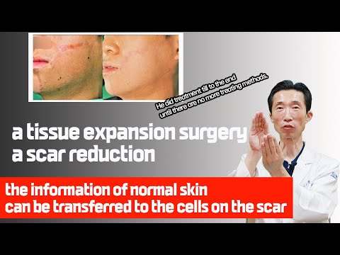 a tissue expansion surgery in an university hospital.