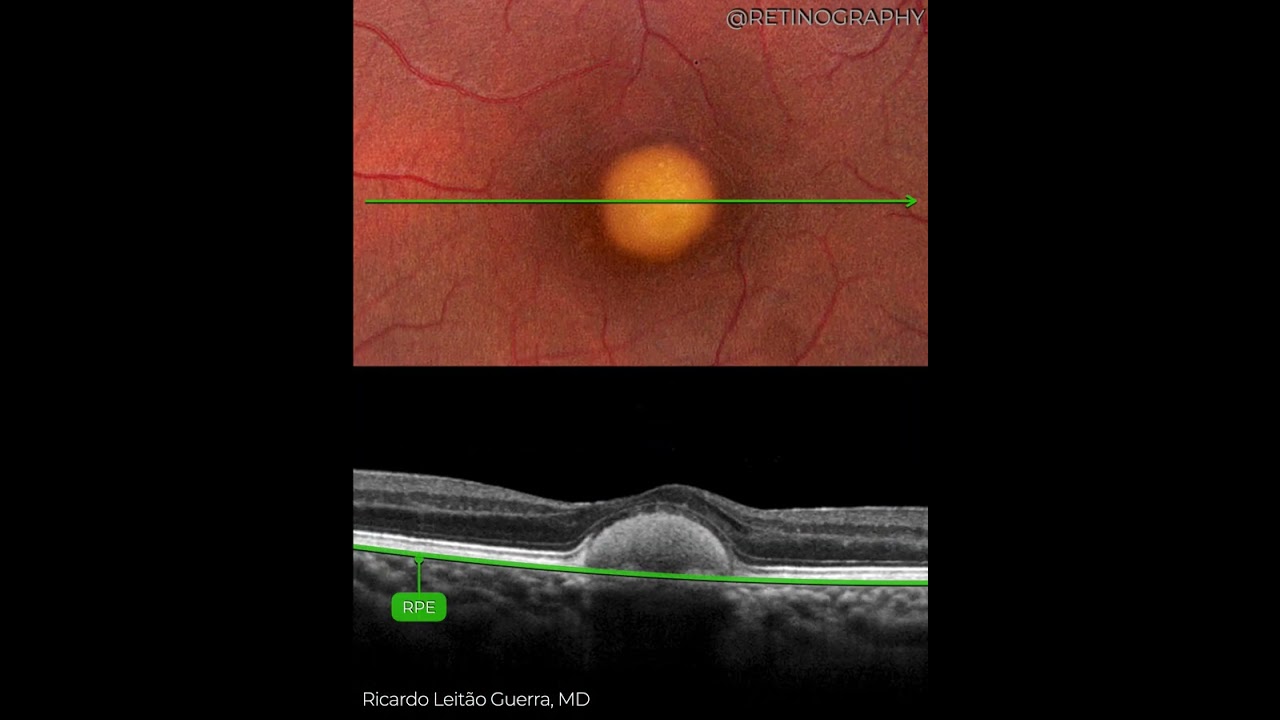 Vitelliform Dystrophy - Multimodal Imaging Analysis