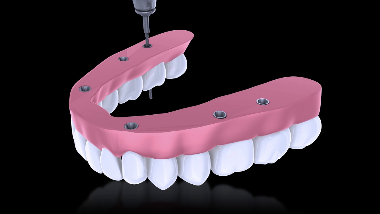 Introducing the Smart Denture Conversions System