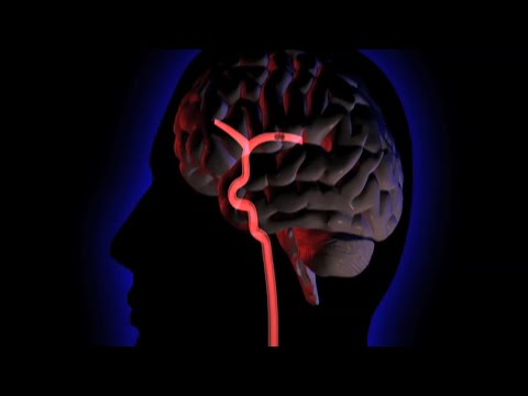 Stroke Care