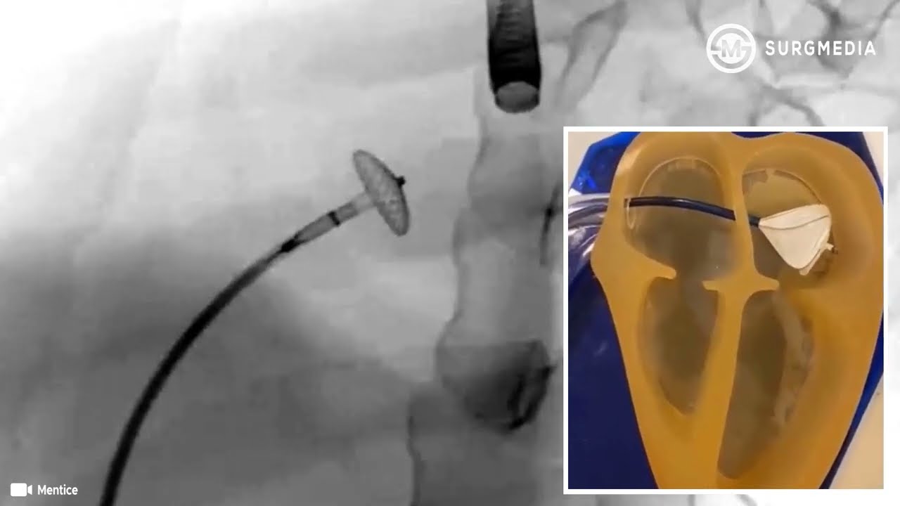 How it works? Transcatheter closure of Atrial Septal Defect (ASD)