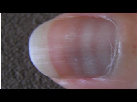 BE CAREFUL ABOUT THESE NAILS- Mees Lines