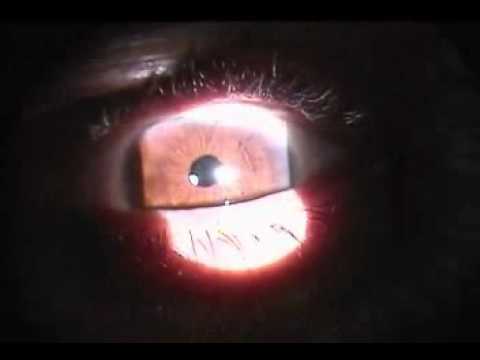 pseudophakic and glaucoma operated eyes