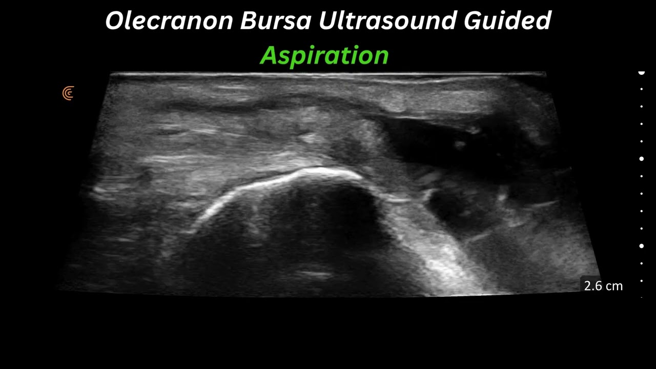 Olecranon Bursa Ultrasound Guided Aspiration & Injection