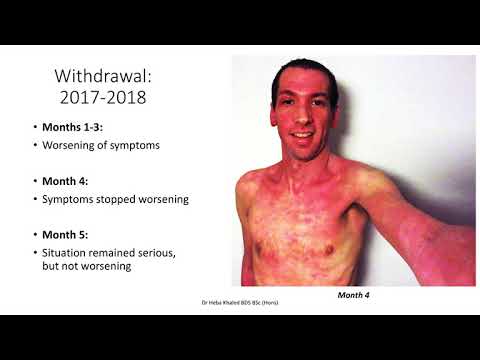 TSW (Topical Steroid Withdrawal) Case Example: Santiago Aufranc