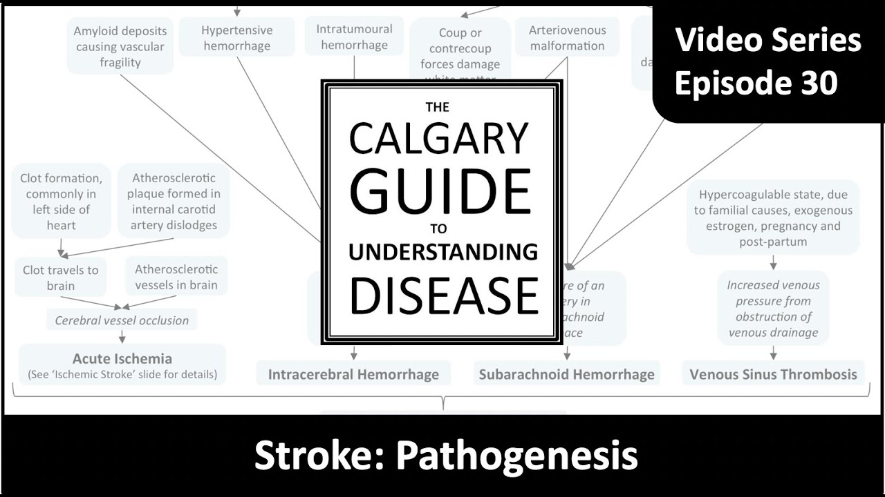 Stroke Pathogenesis (with a focus on Ischemic Stroke)