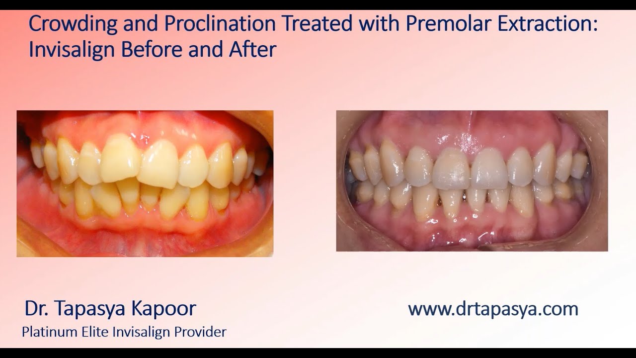 Crowding and Proclination Treated with Premolar Extraction: Invisalign Before and After