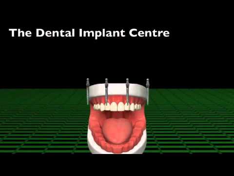 Mini Dental Implants Mt Pleasant, SC Joseph Gillespie DDS The Dental Implant Centre
