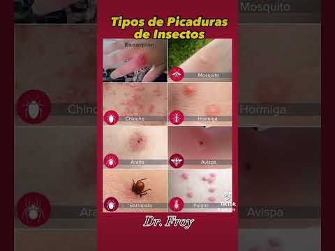 Picaduras de Insectos🦟🕷