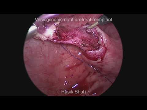 Short video clip of Vesicoscopic Ureteral Reimplant