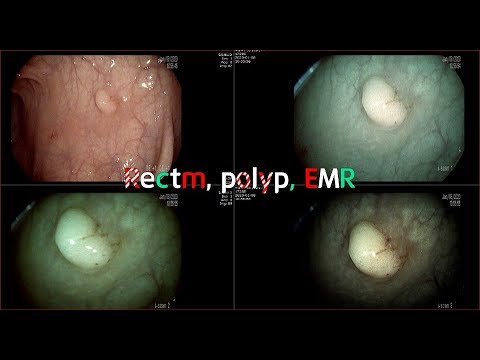 small sessile polyp, rectum, EMR