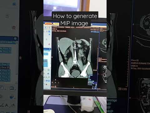 how to generate MIP images. #philips #angiography #planning #ctscan