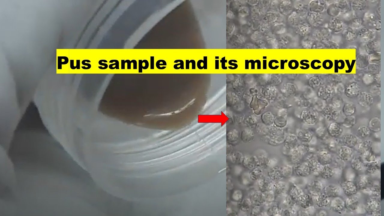 Pus sample and its microscopy