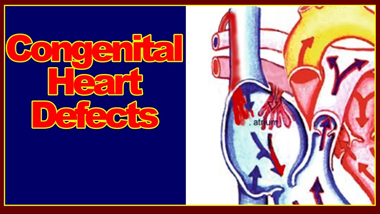 Congenital Heart Defects, Pulmonary Hypertension and  Eisenmenger Syndrome. Part #1 Board Review