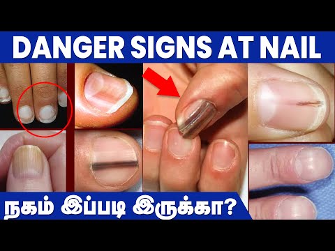 இந்த அறிகுறி இருந்தால் ஆபத்தா? | Nails Problem | IBC Health