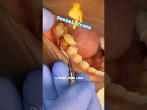 ZIRCONIA DENTAL CROWN