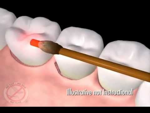 Laser dental treatment of gum disease dentists and dental care sydney castle hill Call 02 9659 1200