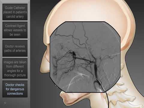 Embolization Procedure