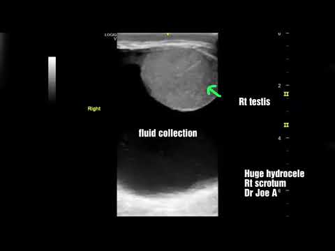 Huge hydrocele Rt scrotum ultrasound video