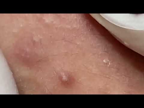 Acne Treatment New 2025 | Blackheads & Whiteheads Removal Mimi channel 027