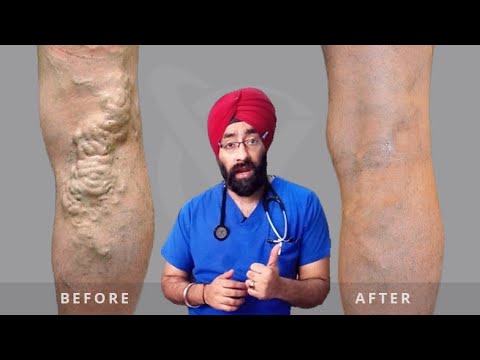 Varicose Vein Treatment - Non Invasive | Dr.Education