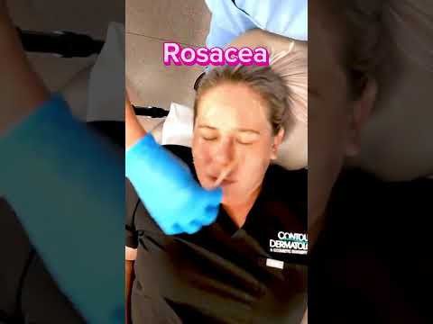 She Wanted the IPL Laser for Her Spots...