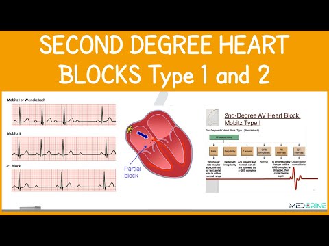 Second Degree Heart Block | Mobitz I & II ECG Interpretation Simplified