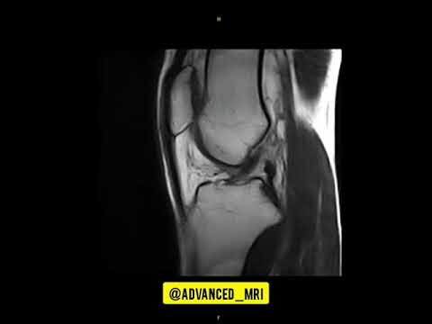 dynamic MRI of knee