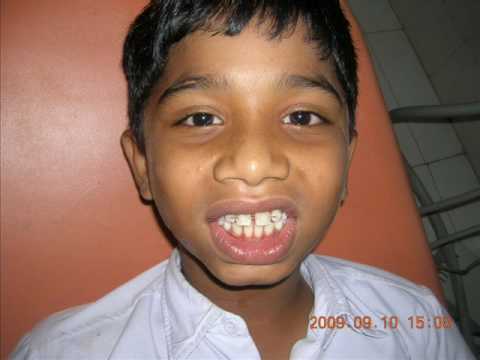 REIMPLANTATION OF TOOTH