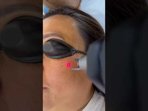 Pigmentation Treatment in Dubai Marina by Dr Erfan at Queens Medical Center ????????