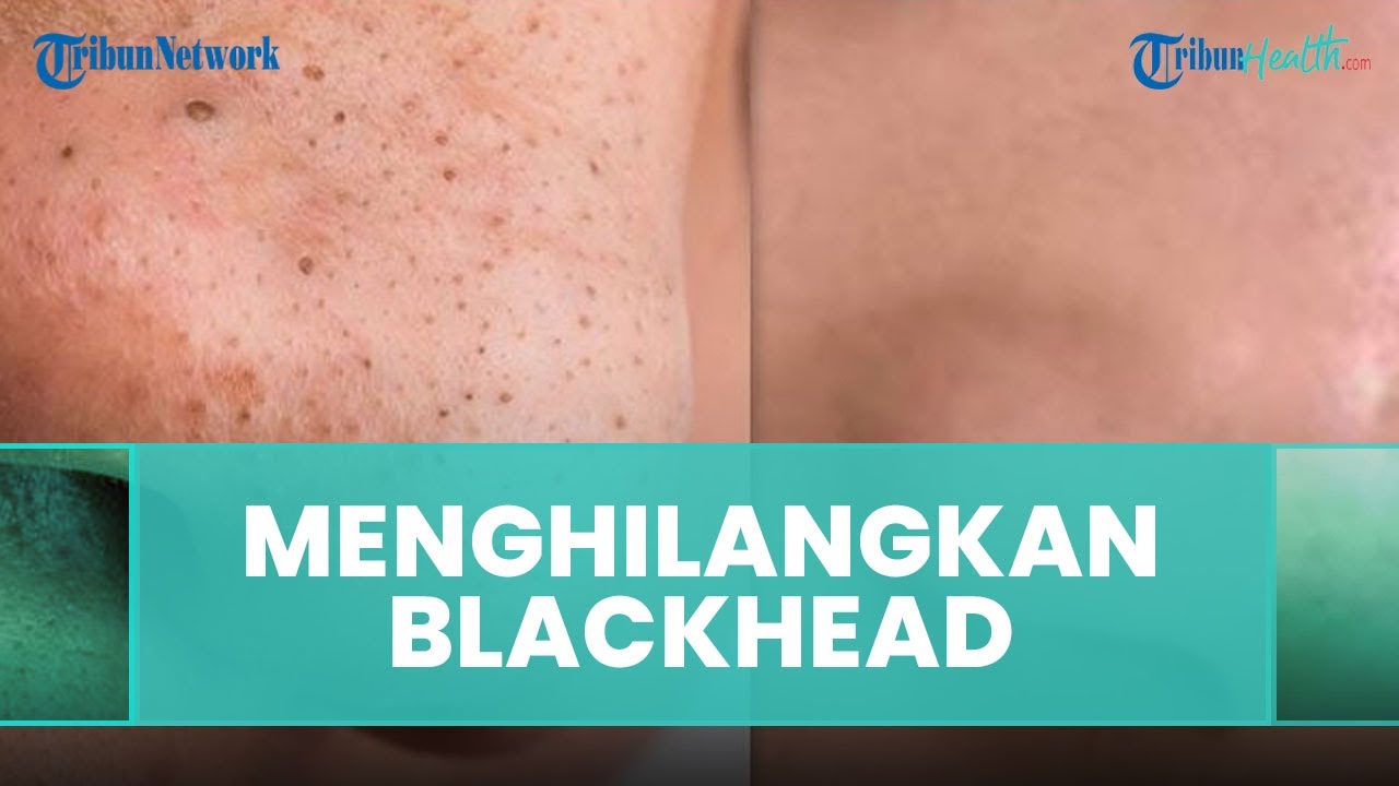 Begini Cara Menangani Komedo Hitam atau Blackhead yang Baik dan Benar ...