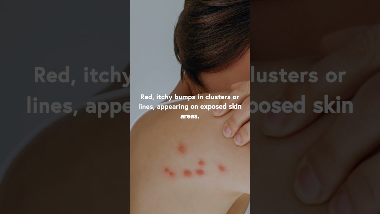 Identify Bed Bug Bites With These Simple Tips!