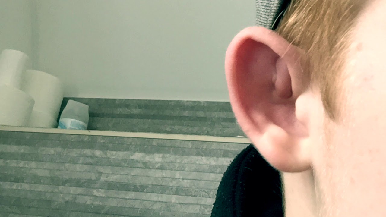 Cauliflower ear transformation (Before and after)