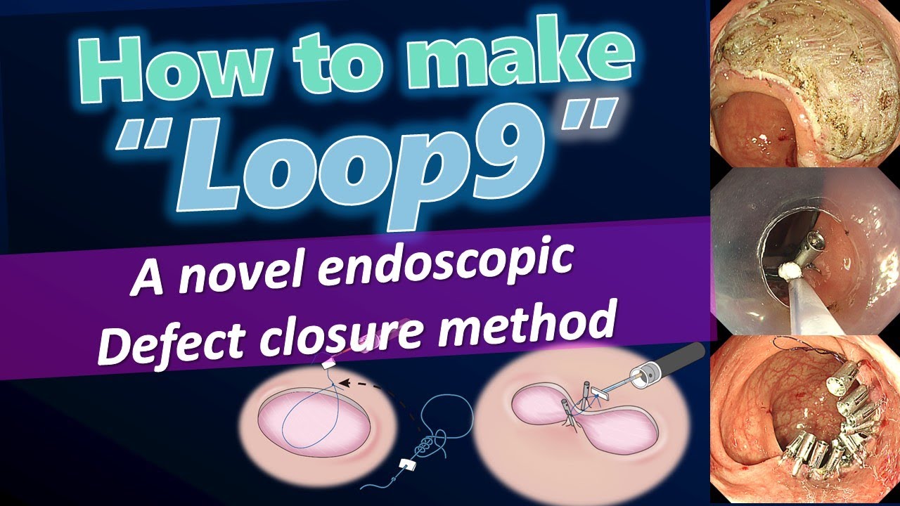 How to make Loop9  -Novel endoscopic defect closure method-