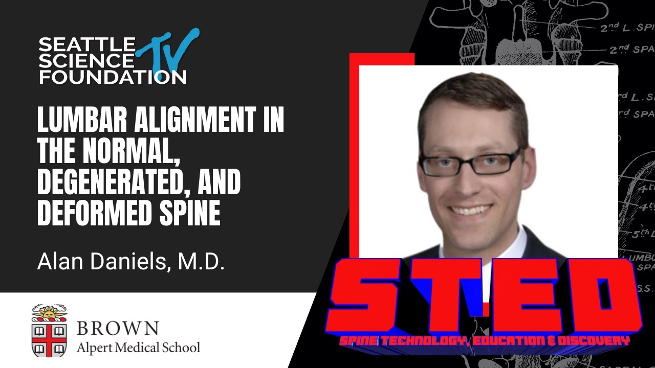 Lumbar Alignment in the Normal, Degenerated, and Deformed Spine – Alan Daniels, MD