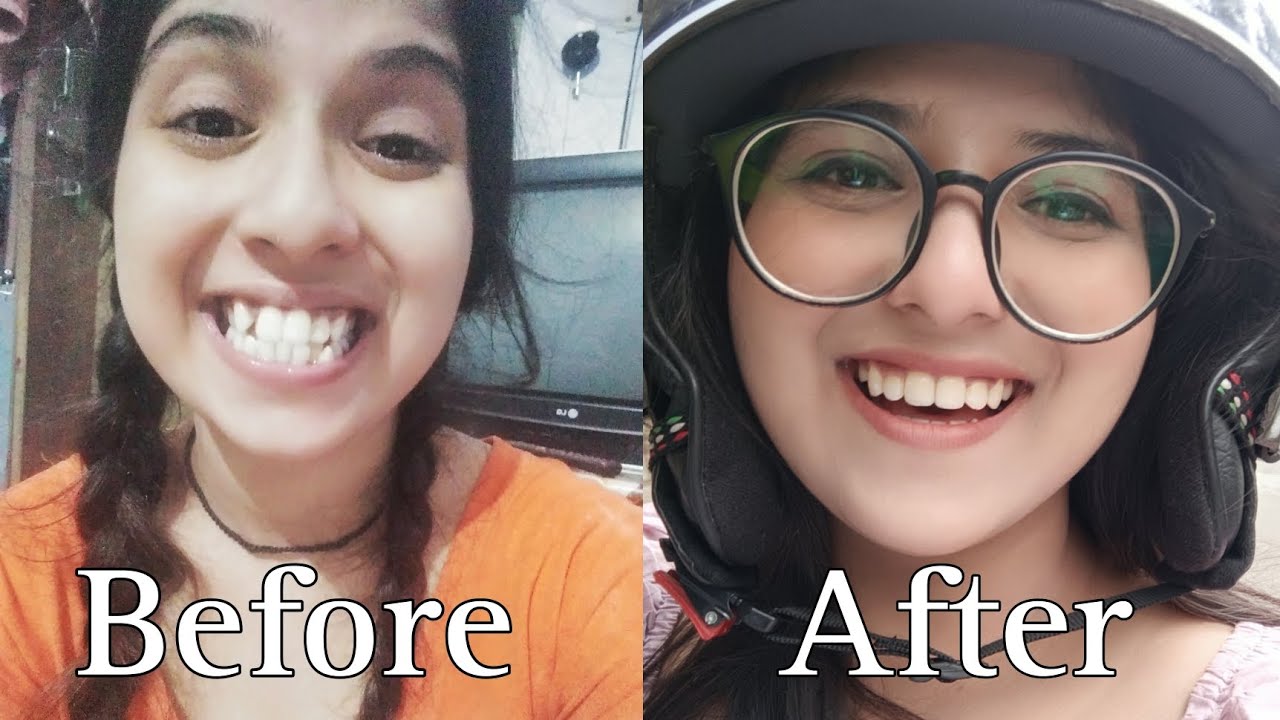 TEETH TRANSFORMATION |  BEFORE VS AFTER BRACES