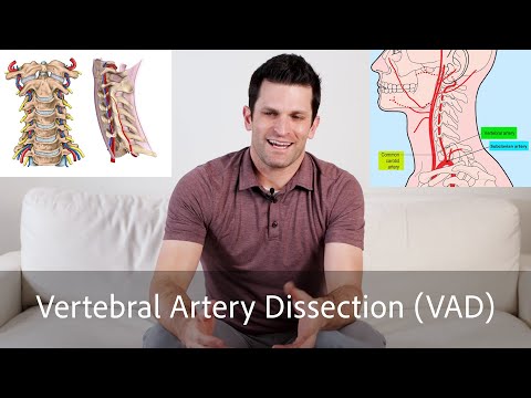 Vertebral Artery Dissection