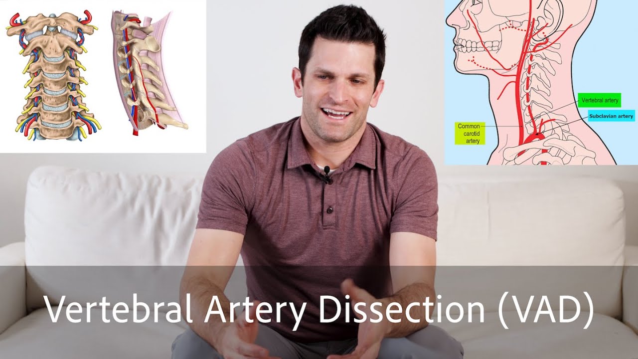 Vertebral Artery Dissection