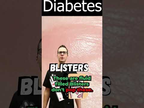 Blister on Foot, Toe or Between Toes? [Diabetic Skin Symptoms]