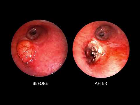 Endobronchial Hamartoma