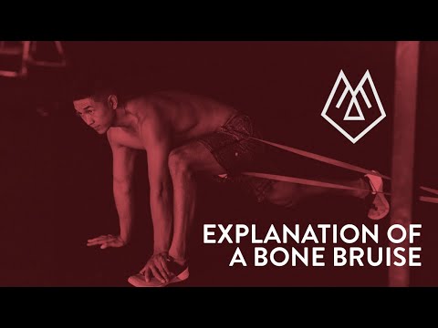 Bone Bruises Decoded: Causes & Recovery | Dr. Jackson | The Sports Pod