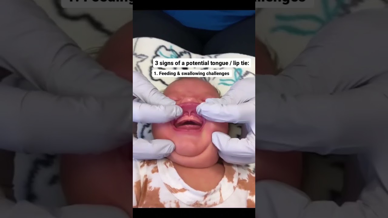 3 Signs of a Potential Tongue Tie