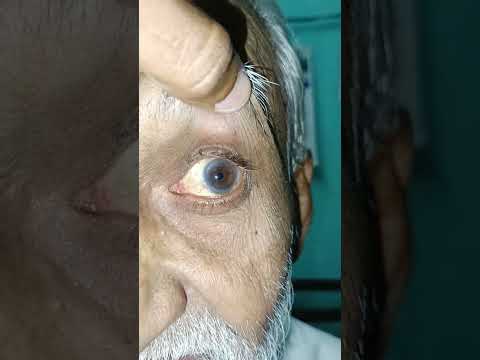 #pseudophakia #cataract #drmaateeq