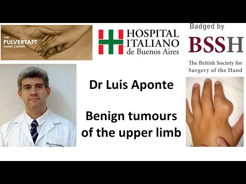 Management of benign tumours of the upper limb by Dr Luis Aponte