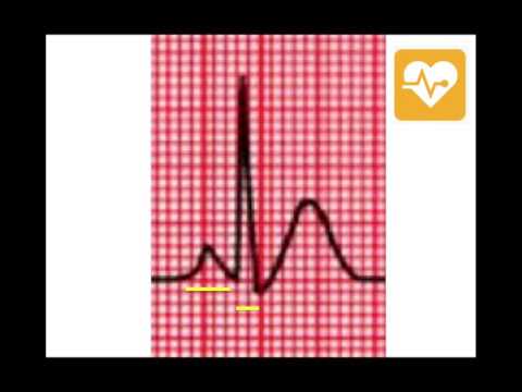 ECG Black Belt Program: Yellow Belt Level: ECG Question & Solution # 1