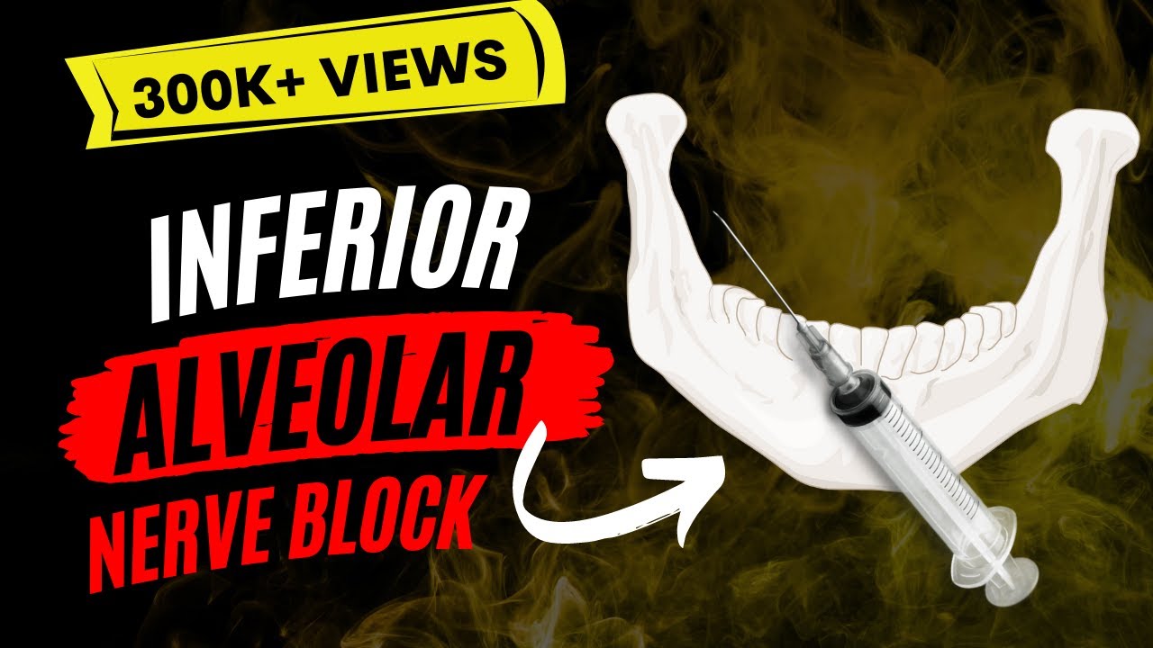 Inferior Alveolar Nerve block IANB