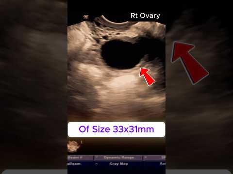 FOLLICULAR CYST - ULTRASOUND | 14th Day Follicle Tracking #ultrasound #infertility #ovulation