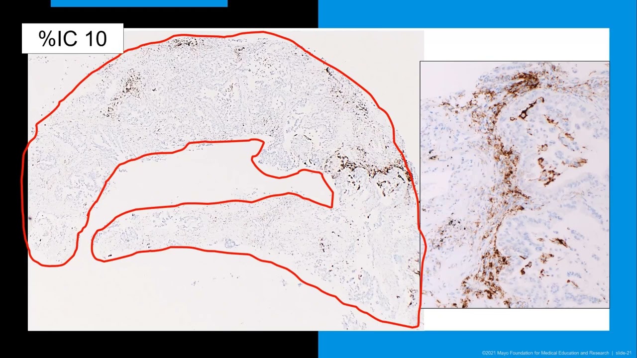 PD-L1 Testing by Immunohistochemistry