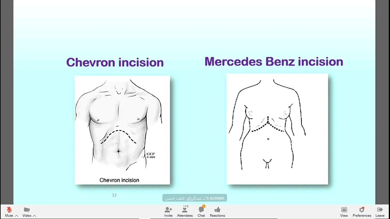 Abdominal Wall Incisions  & Sutures part 1